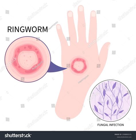 Ringworm Over 885 Royalty Free Licensable Stock Illustrations
