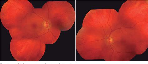 Figure 1 From Structure Functional Correlation Using Adaptive Optics Oct And Microperimetry In