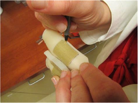 Proximal Interphalangeal Joint Extension Block Splint Jack