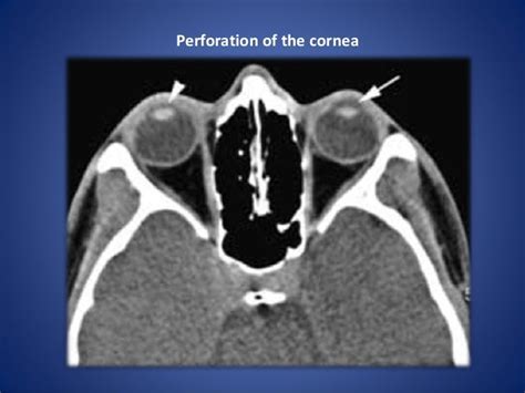 Orbital Pathologies Radiology