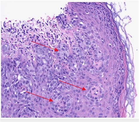 Figure 2 From Scrotal Extramammary Pagets Disease In An Elderly