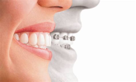 Invisalign The Clear Alternative To Braces Artofit