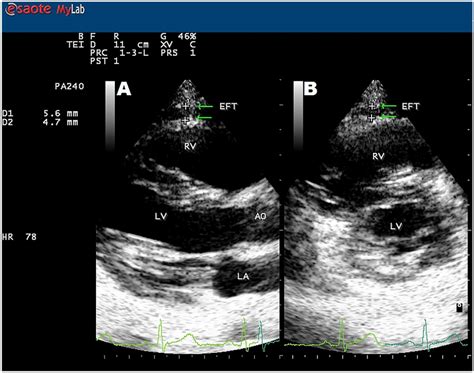 Echocardiographic Measurement Of Epicardial Fat Thickness A Long Axis