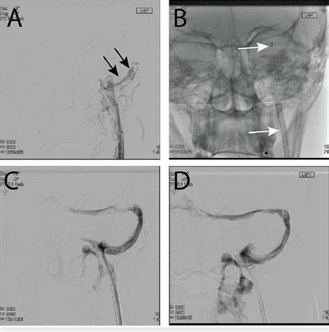 Digitally Subtracted Angiography Of The Cerebral Venous System