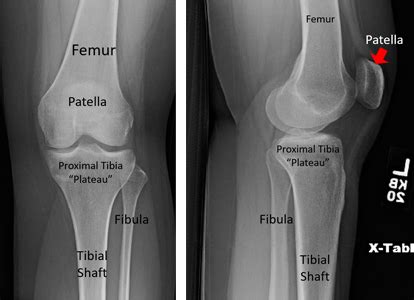 Recovery Tibial Plateau Fracture Tibial Plateau Fractures Artofit