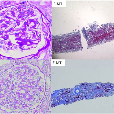 Renal Biopsy Findings A First Biopsy Light Microscopy Displays
