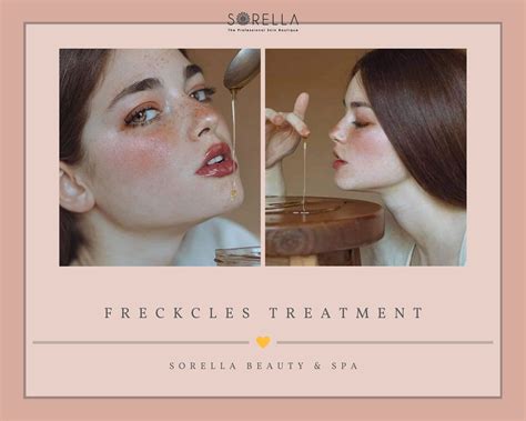 Freckles Treatment 5 Methods To Get Rid Of Freckles Sorella Beauty