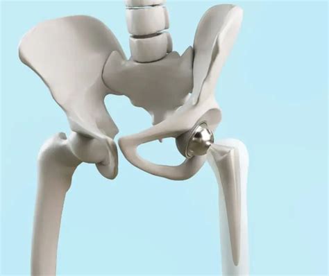 Been Told You Need A Hip Replacement Completely Aligned