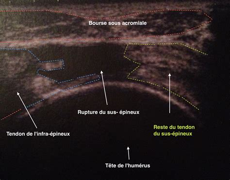 La rupture de la coiffe des rotateurs par l Unité de chirurgie de l