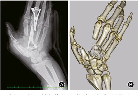 Figure 2 From Severe Hand Contracture Treated By External Fixation