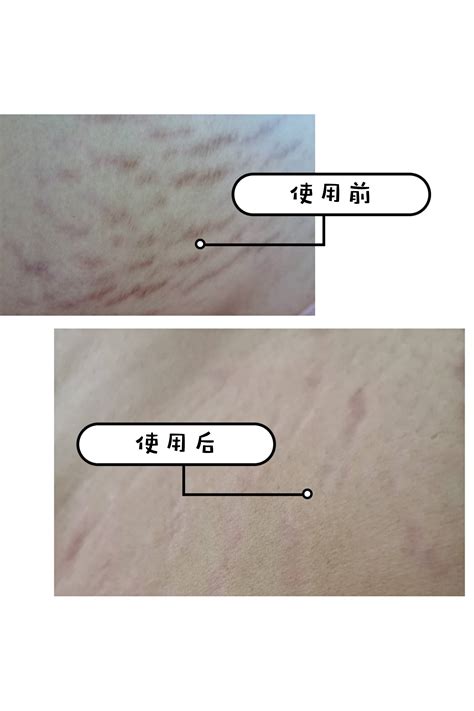 孕期干活 孕纹涂抹手法教程 搜狐大视野 搜狐新闻