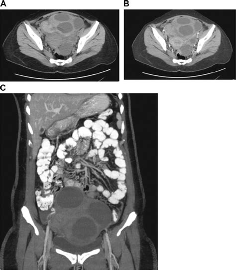 Ct Scan Abdomen Pelvis With Contrast Images And Photo