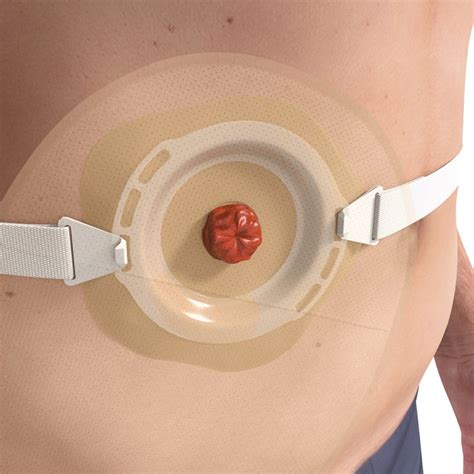 Stoma Leakage Why Does My Ostomy Bag Leak B Braun Australia B Braun
