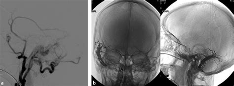 Transverse And Sigmoid Dural Arteriovenous Fistula Neupsy Key