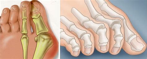 Захворювання стопи халлюкс вальгус Hallux Valgus