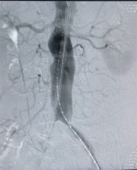 Cristian Ovidiu Ghitoiu On Linkedin Do You Know Remember This Aorfix™ Endovascular Stent Graft