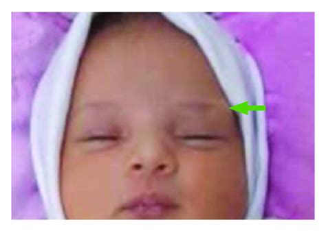 Periorbital Dermoid Cyst Presented In A Neonate Download Scientific