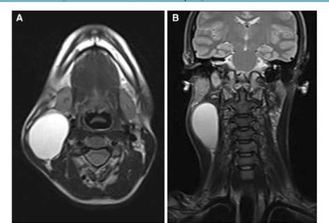 Figure 2 From Second Branchial Cleft Cyst A Case Report Semantic Scholar