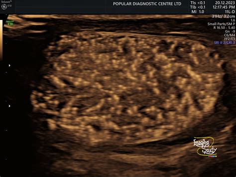 Case 112 Testicular Early Subacute Torsion And Diffuse Microlithiasis