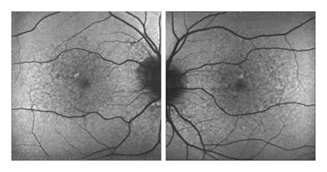Progression Of Rpe Macular Atrophy Images From Patient 1 From July