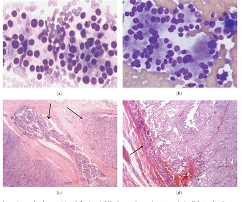 Figure 2 From Comparison Of Fine Needle Aspiration Cytology And Thyroid Scan In Solitary Thyroid