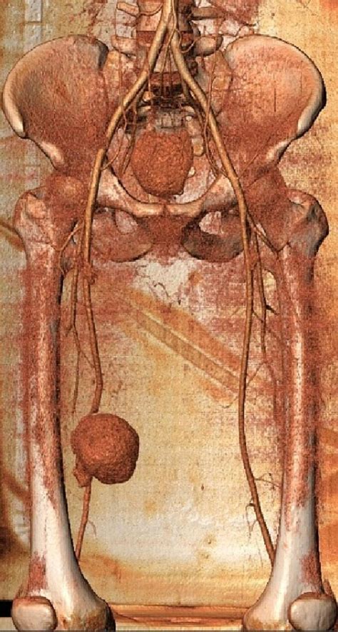 Vasculo Behçets Disease With A Giant Pseudoaneurysm Of Superficial Femoral Artery A Case