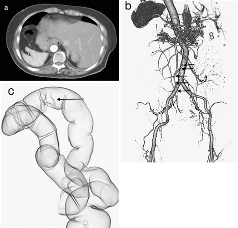 Figure 1 From Laparoscopic Sigmoidectomy For A Patient With Situs