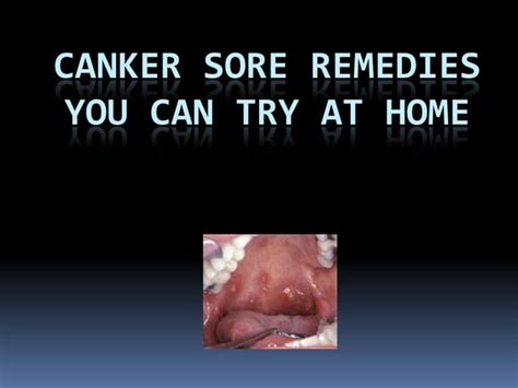Natural Remedies For Canker Sores Ppt