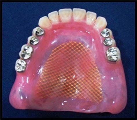Prosthesis On Prosthesis Three Fourth Metal Crowns—a Novel Approach For Metallic Occlusion