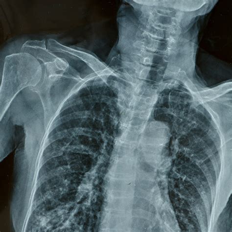 Understanding Hiatal Hernia Diagnosis And Barium Swallow Test Dr