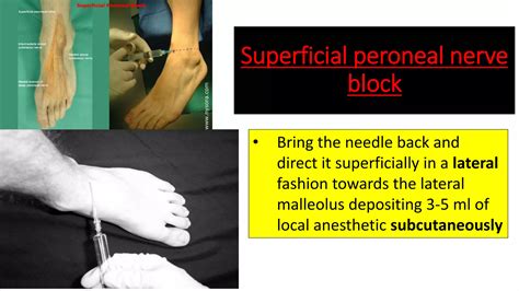 Peripheral Nerve Blockankle Blockwrist Block Digital Block Pptx