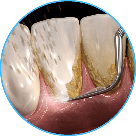 Scaling And Root Planing Houston TX Friedberg Assoicates