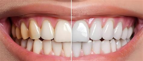 Premium Photo Smile Transformation From Dull To Dazzling Concept