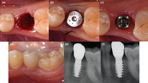 Immediate Versus Delayed Implant Placement Of Novel Fully Tapered Tissue‐level Implants A