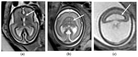 Clinical Applications Of Fetal Mri In The Brain