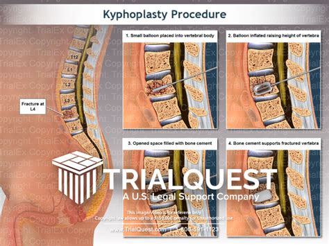 Kyphoplasty Procedure Trialexhibits Inc