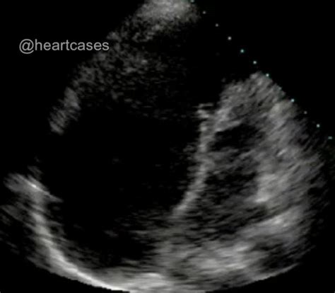 Echo Case 8 Ebstein Anomaly