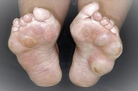 Lump On Bottom Of Foot No Pain Hot Sale Emergencydentistry