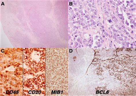 Diffuse Large B Cell Of The Appendix The Appendix Wall Showed A Download Scientific Diagram