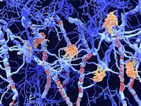 Multiple Sclerosis Ms Microglia Cells Photograph By Juan Gaertner Fine Art America