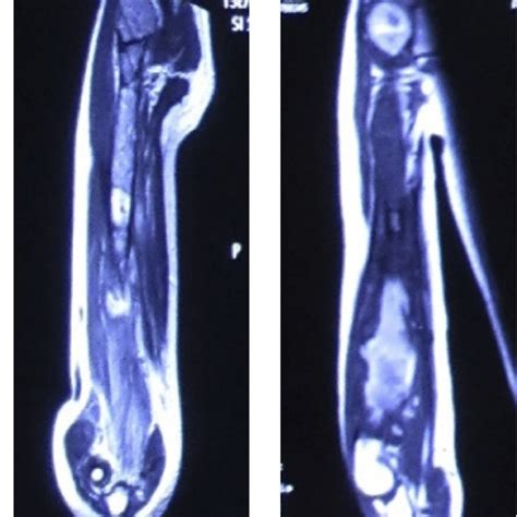 Anteroposterior And Lateral Radiograph Of Humerus A Initial State B
