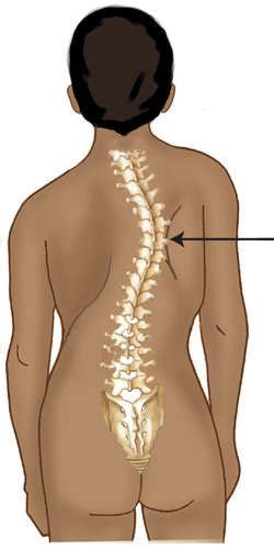 7 Dextroscoliosis Thoracic Ideas Thoracic Scoliosis Scoliosis