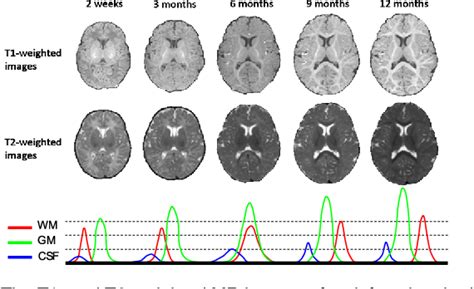 Figure 2 From Benchmark On Automatic Six Month Old Infant Brain Segmentation Algorithms The