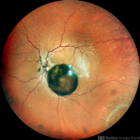 Vitreous Cyst Retina Image Bank