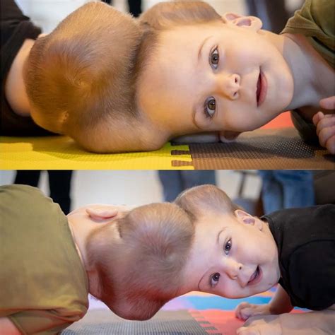 Tissue Expansion Performed To Enable Separation And Craniofacial Download Scientific Diagram