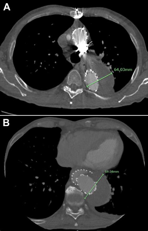 A Axial Computed Tomography Angiogram Cta At 4 Months Of Follow Up