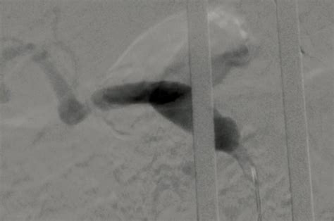 Renal And Mesenteric Aneurysms Clinical Tree