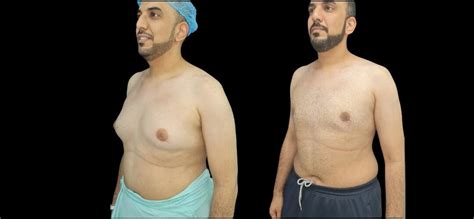 Benefits Of Choosing The Best Gynecomastia Surgeons In Dubai For Male Breast Reduction