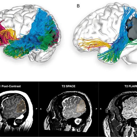 A Cortical Projection Of MLF Fibres Yellow With Numbered BAs Which Download Scientific