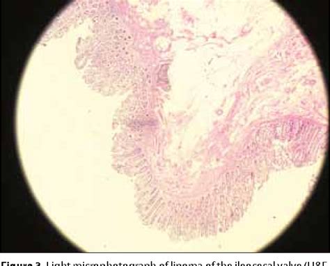 Figure 3 From Pedunculated Obstructive Lipoma Of The Ileocecal Valve A